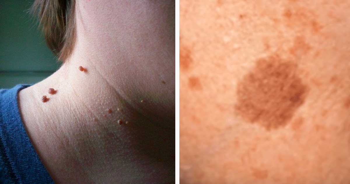 25+ ways to naturally resolve skin tags, warts, moles, blackheads, and ...